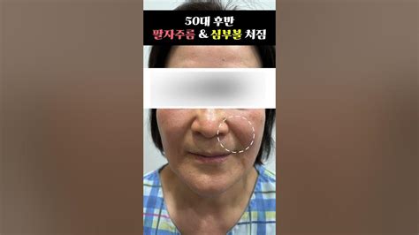 50대 후반 팔자주름 심부볼 처짐 미니리프팅으로 완벽해결 한달차 변화 모든 시술수술은 부작용이 있을 수 있습니다 모즈클리닉