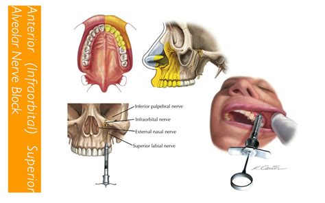 Infraorbital Nerve Block