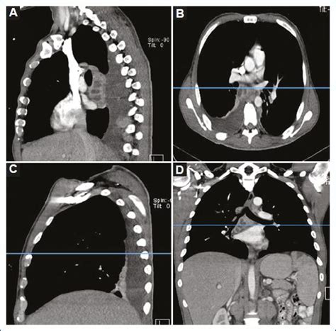 Posterior Basal Segments Atelectasis In Descending Necrotizing Mediastinitis