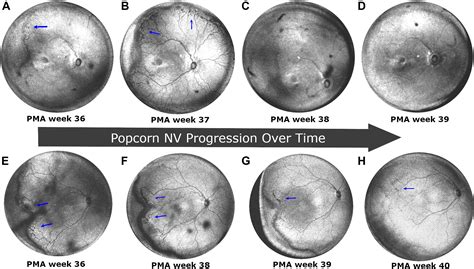 Isolated Retinal Neovascularization In Retinopathy Of Prematurity Ophthalmology Retina