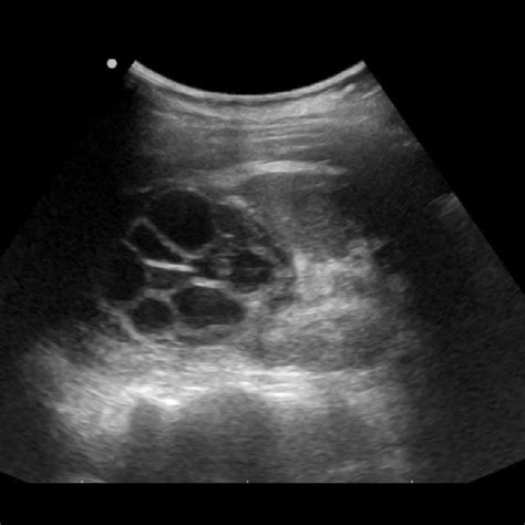 Transabdominal Ultrasound Findings Showing A Large Complex Cystic Mass