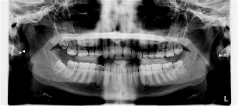 Impacted Wisdom Teeth Rxrays