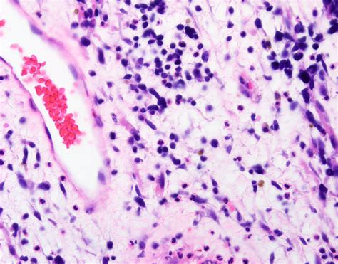 Sarcoma Botryoides Urethra