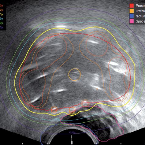 Dose Volume Histogram From The Hdr Brachytherapy Prostate Procedure Download High Quality