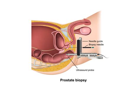 Transperineal Vs Transrectal Prostate Biopsy Koelis