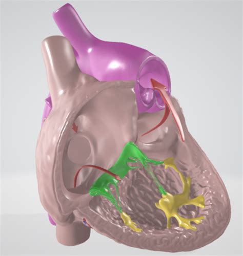 Stl File Truncus Arteriosus Congenital Heart Disease 💜 Obj ・model To Download And 3d Print・cults