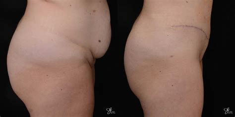 Monsplasty Fupa Reduction Gallery