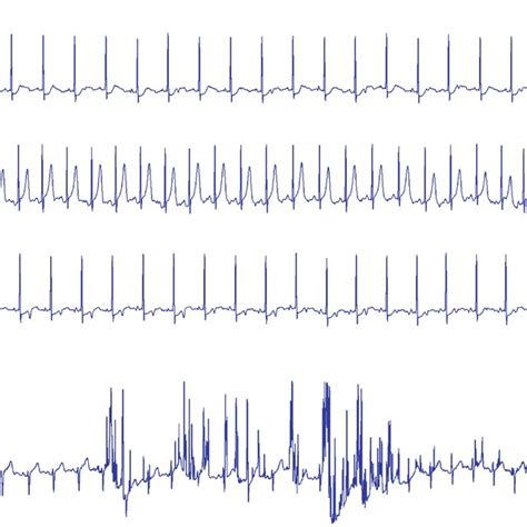The Ecg Of A Normal Heartbeat A Heartbeat Of A Two Lead Aecg Record Download Scientific