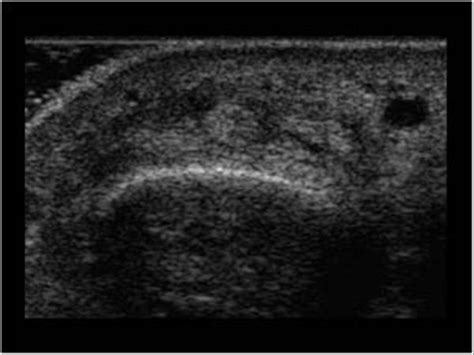 Musculoskeletal Joints And Tendons 6 4 Fingers Case 6 4 1 Tenosynovitis Ultrasound Cases