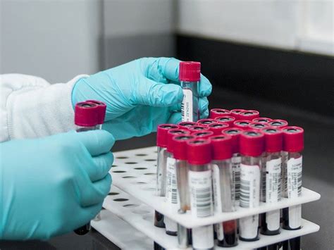 Ревматоиден фактор (RF) – кога е повишен? | ArsMedica.bg