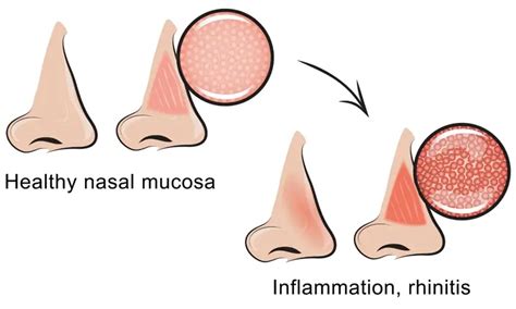 Rhinitis Là Gì Tìm Hiểu Định Nghĩa Nguyên Nhân Và Các Triệu Chứng Của
