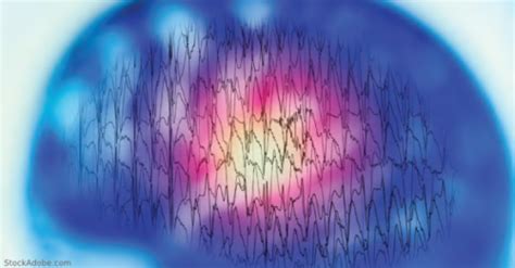 The Current Status Of Continuous Seizure Management Acep Now