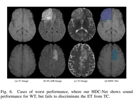 Hdc Net Hierarchical Decoupled Convolution Network For Brain Tumor Segmentation 九叶草的blog