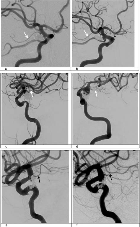 Initial Coil Embolization And Recanalization Of Fetal Type A And B Download Scientific