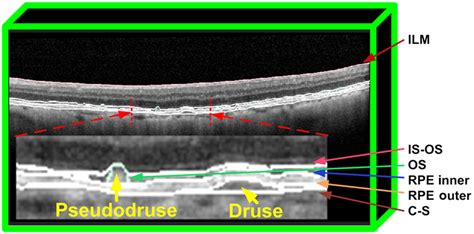 Illustration Of The Multiple Layer Segmentation Including The Rpd And