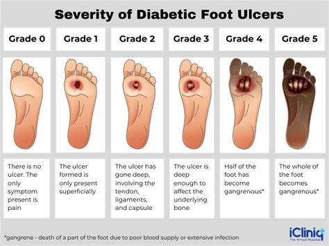 What Is An Ulcer On Foot Outlet