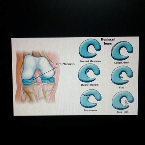 Meniscus Injury Mnemonics Epomedicine