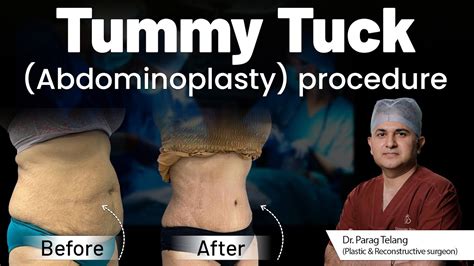 Tummy Tuck Complete Procedure Dr Parag Telang Tummy Tuck Surgery