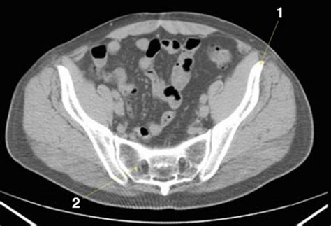 Image Noncontrast Ct Scan Of The Abdomen And Pelvis Showing Normal