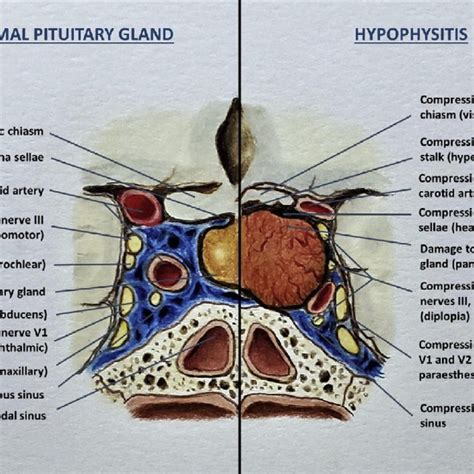 Pdf Hypophysitis An Update On The Novel Forms Diagnosis And Management Of Disorders Of