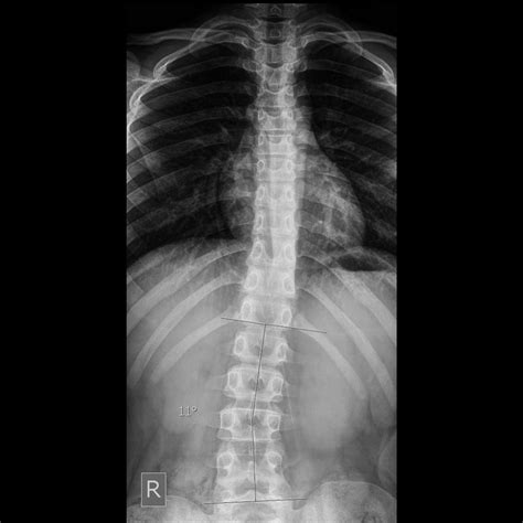 Osteoid Osteoma Spine
