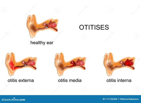Ear Otitis Media Internal External Stock Vector Illustration Of