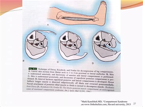 Compartment Syndrome Acute Chronic Anatomy And Operation Ppt