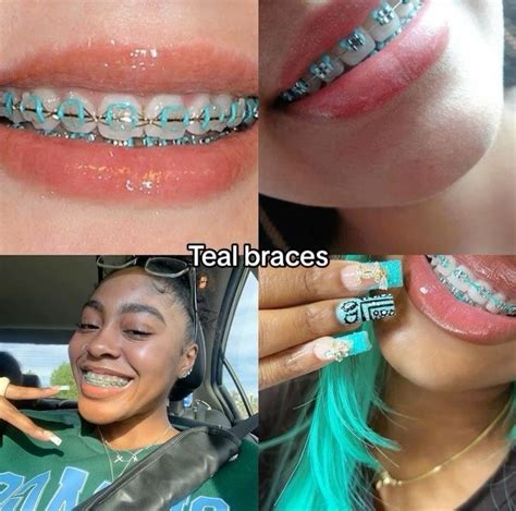 Teal Braces Cute Braces Braces Colors Teeth Braces