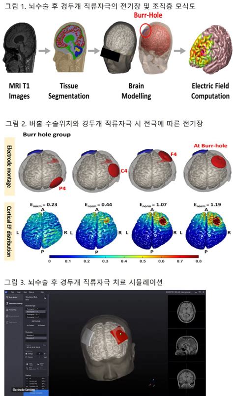 Electronic Drug Direct Current Stimulation Of The Transcranial Head A Sportschosun