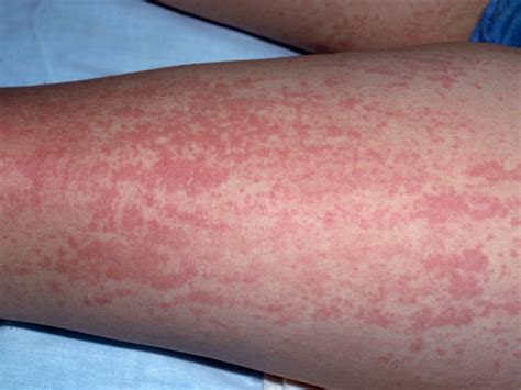 Ras Syndrome Medical At Jill Ford Blog