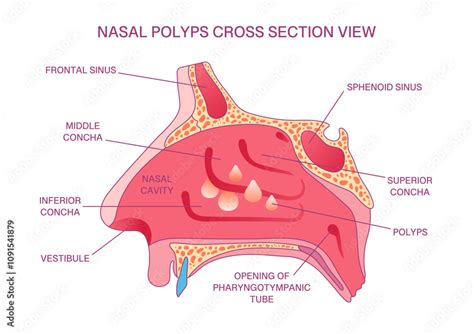 Plagát Labeled Nasal Polyps Cross Section Diagram Nasal Cavity