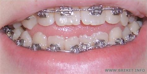 Фото • Открытый Прикус • Альбом • Курс моего лечения в картинках • Брекет Info