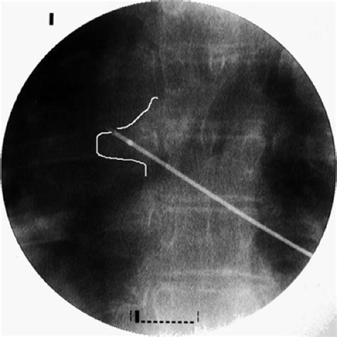 Percutaneous Neural Destructive Techniques Anesthesia Key