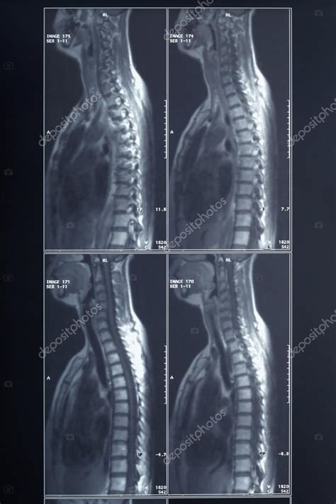 X Ray Spine And Neck Stock Photo By Andreaa
