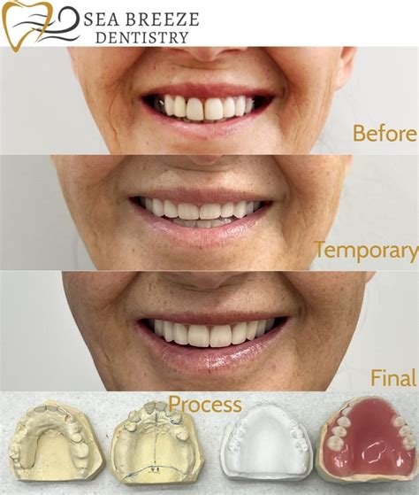 Sea Michelle Came To See Us Seeking New Dentures As Her Old Set Was