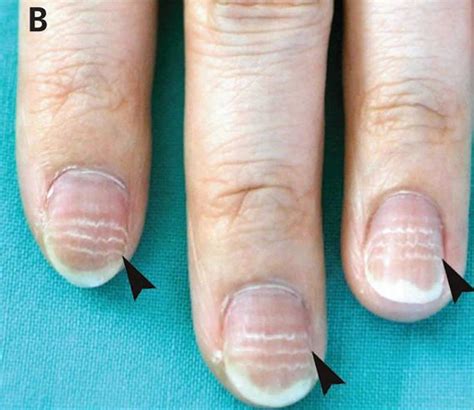 Horizontal Lines In Fingernails Causes At Harrison Trethowan Blog