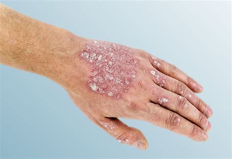 Novedades Sobre Psoriasis 2022 Dermatología