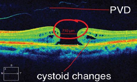 Oct Macula Pvd
