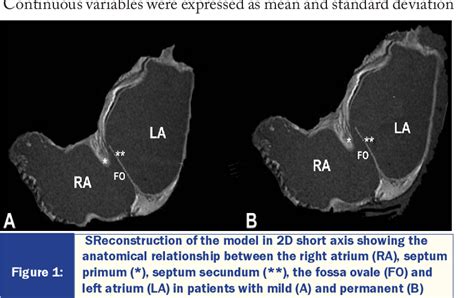 Table 1 From Computational Flow Dynamic Analysis Of Right And Left Atria In Patent Foramen Ovale