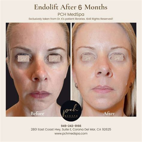 Endolift Los Angeles Ca Best Facelift Laser Pch Medspa