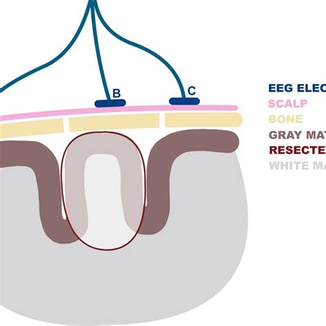 Scalp Eeg Recording Setup Following Epilepsy Surgery Position Of The Download Scientific
