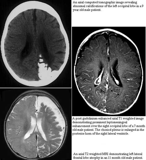 Sturge Weber Mri