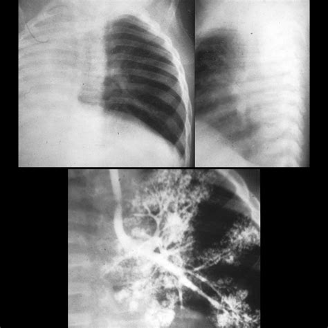 Pulmonary Agenesis Pacs