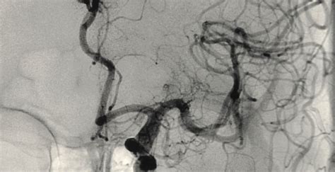 Vaskulitis In Razlaga Simptomi Diagnoza In Prognoza Moja