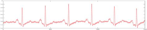 An Arrhythmia Classification Model Based On A Cnn Lstm Se Algorithm