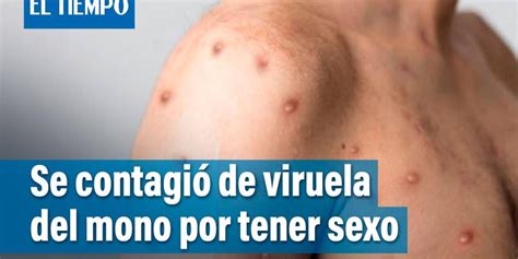 Bogotano se contagió de viruela del mono luego de tener relaciones sexuales