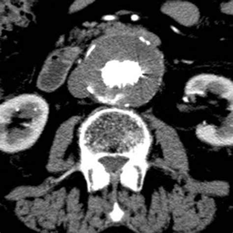 Embolization Of A Type Ii Endoleak From The Ileo Lumbar Branch Of The Left Hypogastric Artery