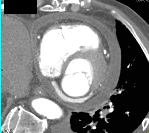 Pericarditis With Thickened Pericardium Cardiac Radiology Case
