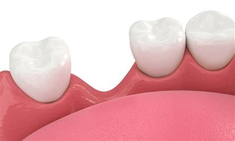 How To Prevent Dental Bone Loss Preventing Bone Loss In Teeth Care