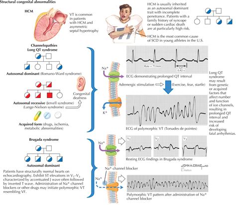 Sudden Cardiac Death Clinical Tree